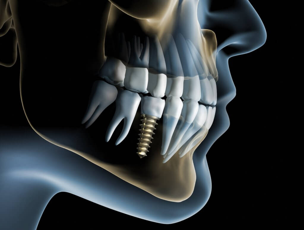 Dental Implants and Bone Loss | Oral & Maxillofacial Associates - OKC