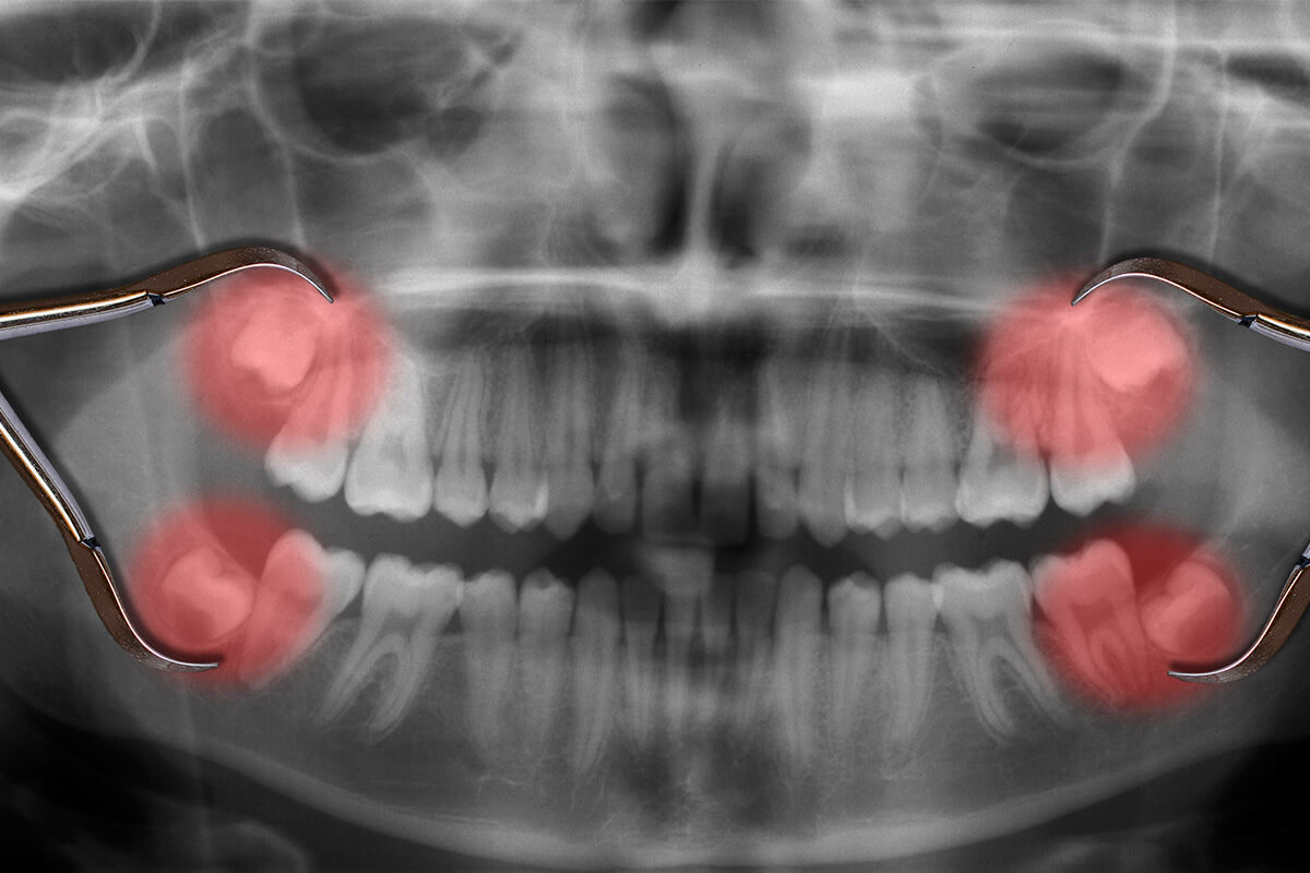 What is an Impacted Wisdom Tooth? | OKC